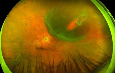 Optomap - Augenzentrum Leinfelden-Echterdingen bei Stuttgart