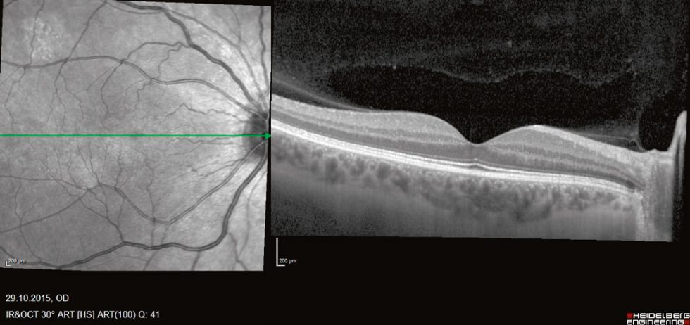 Optische Kohärenztomographie - Augenzentrum Lamparter